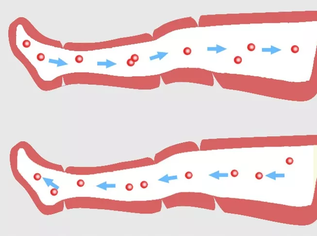 Presoterapie drenaj limfatic masaj de drenaj limfatic masaj picior ...